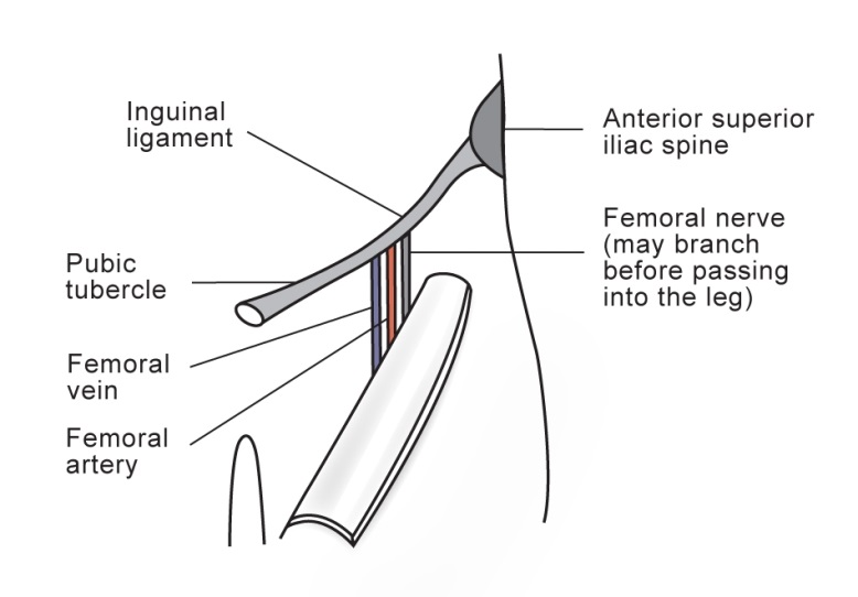 Femoral nerve block