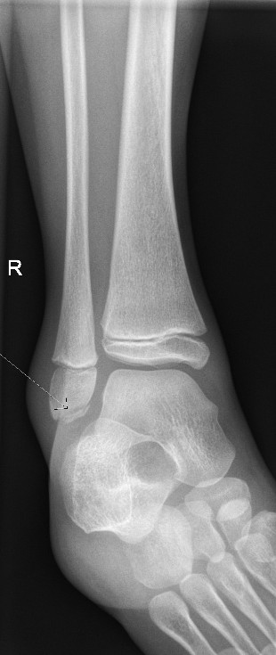 Distal Fibula Fracture