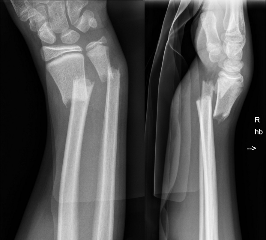 Fractures - Distal forearm or wrist