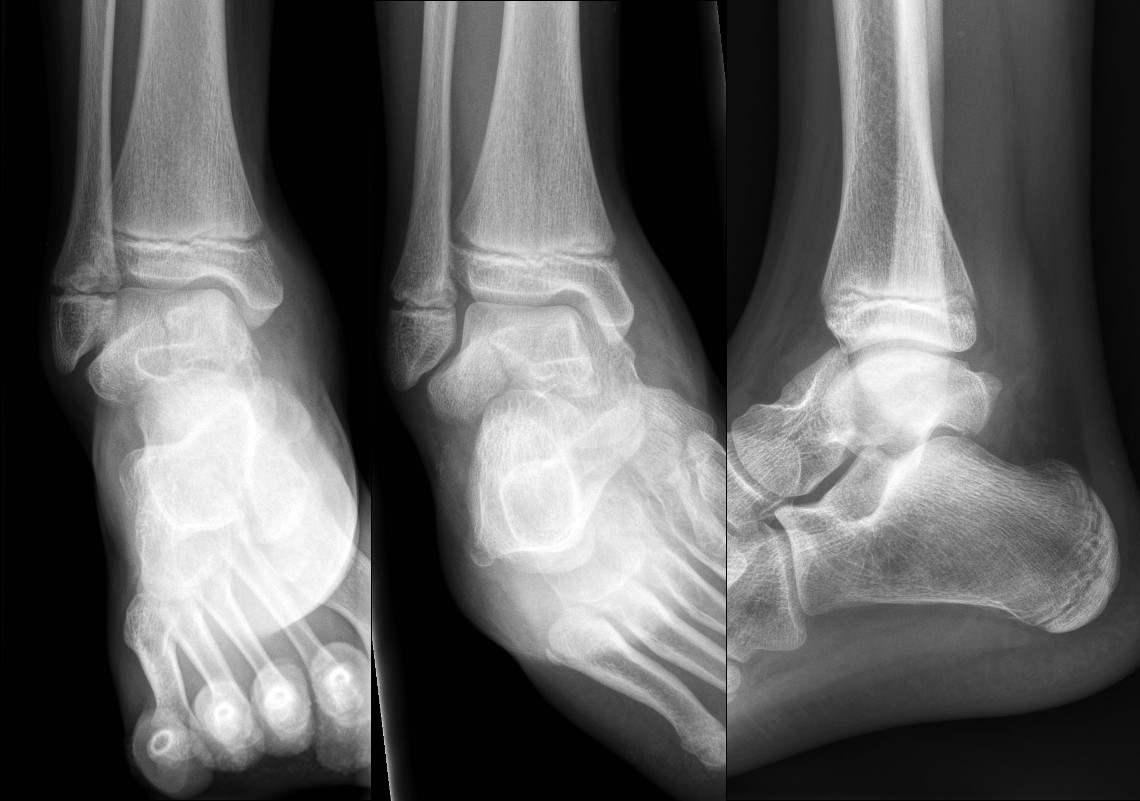 Fractures - Foot